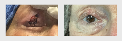 Mohs Surgery FAQ | The Derm Café Podcast